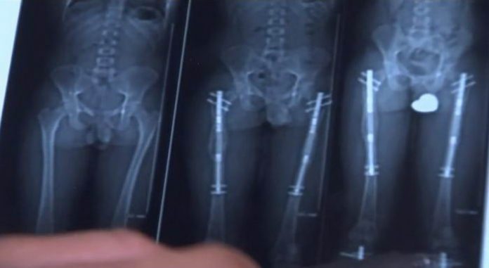 คลินิกแห่งนี้สามารถผ่าตัดยืดขา เพื่อทำให้คุณสูงขึ้นอีก 15 เซนติเมตร ...